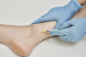 Sclerotherapy Vein Treatment | Sclerotherapy Injections
