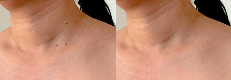 VeinGogh Spider Vein Treatment