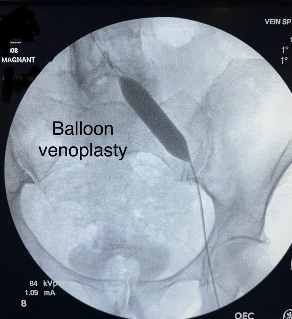 Lasting Relief After Vein Stenting Procedure